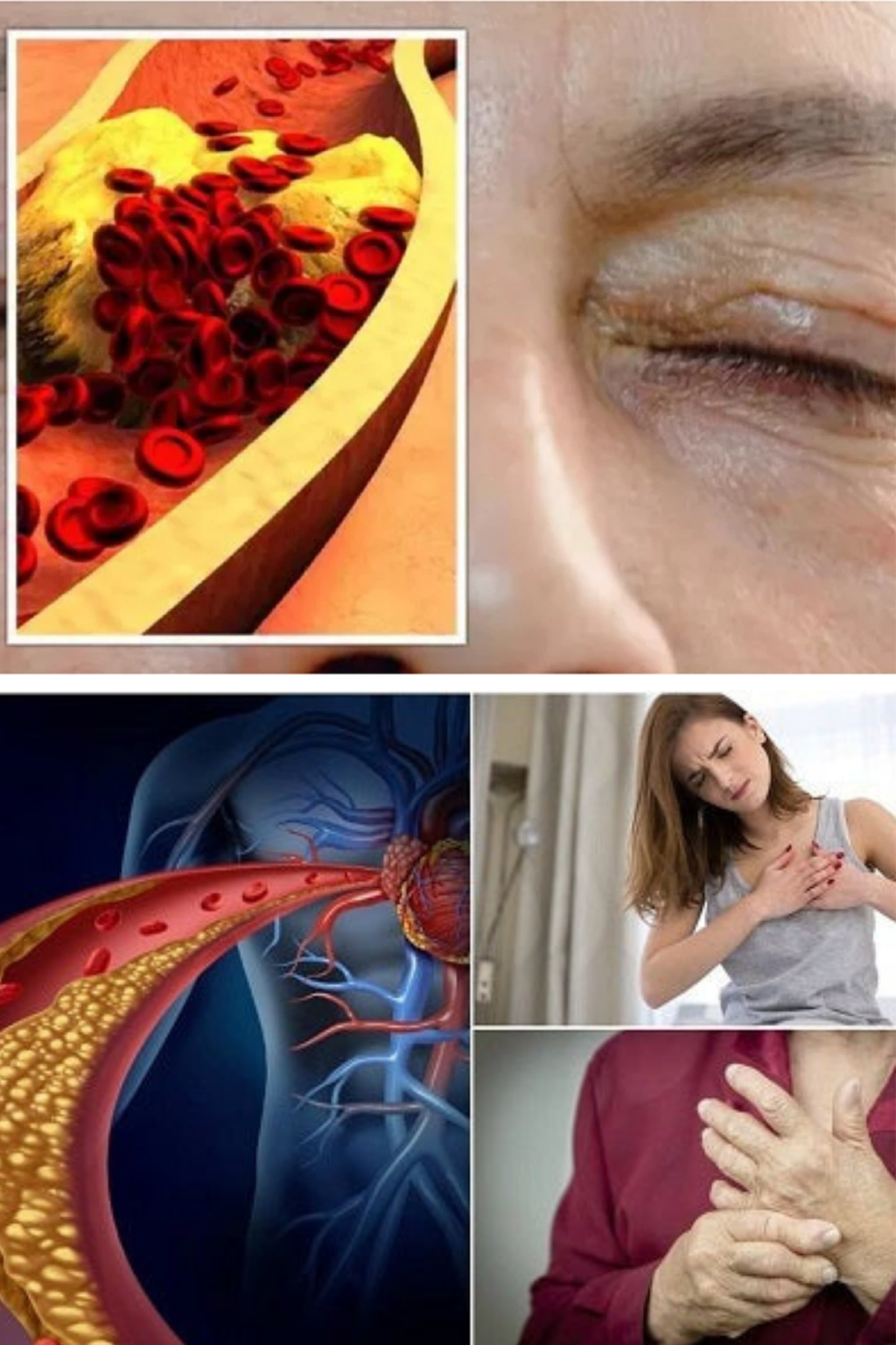 Cele 10 Simptome ale Nivelului Crescut de Colesterol: Semnale de Alarmă ...
